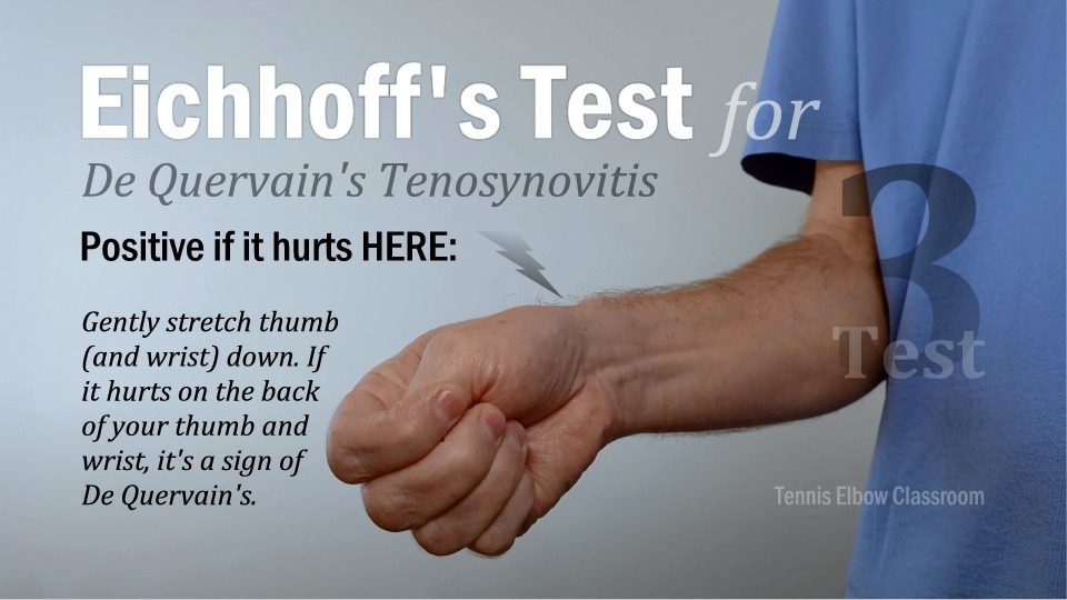 Three Simple Tests For De Quervain’s Tenosynovitis / Mommy Thumb ...